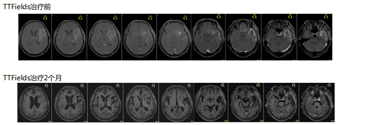 【爱见新生】Stupp方案联合TTFields治疗IDH野生型、1p/19q未缺失、MGMT未甲基化的48岁男性新发GBM一例_患者