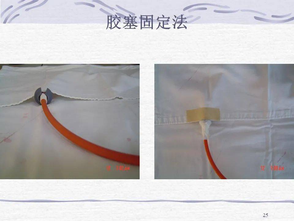 【ppt】三腔二囊管的应用及护理 搜狐大视野 搜狐新闻