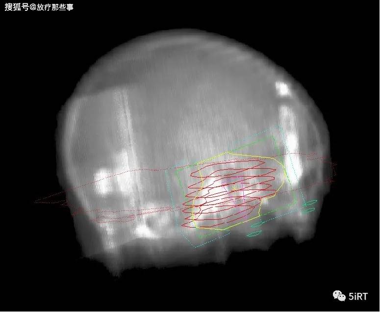 放疗设备数据传输标准DICOM RT_治疗