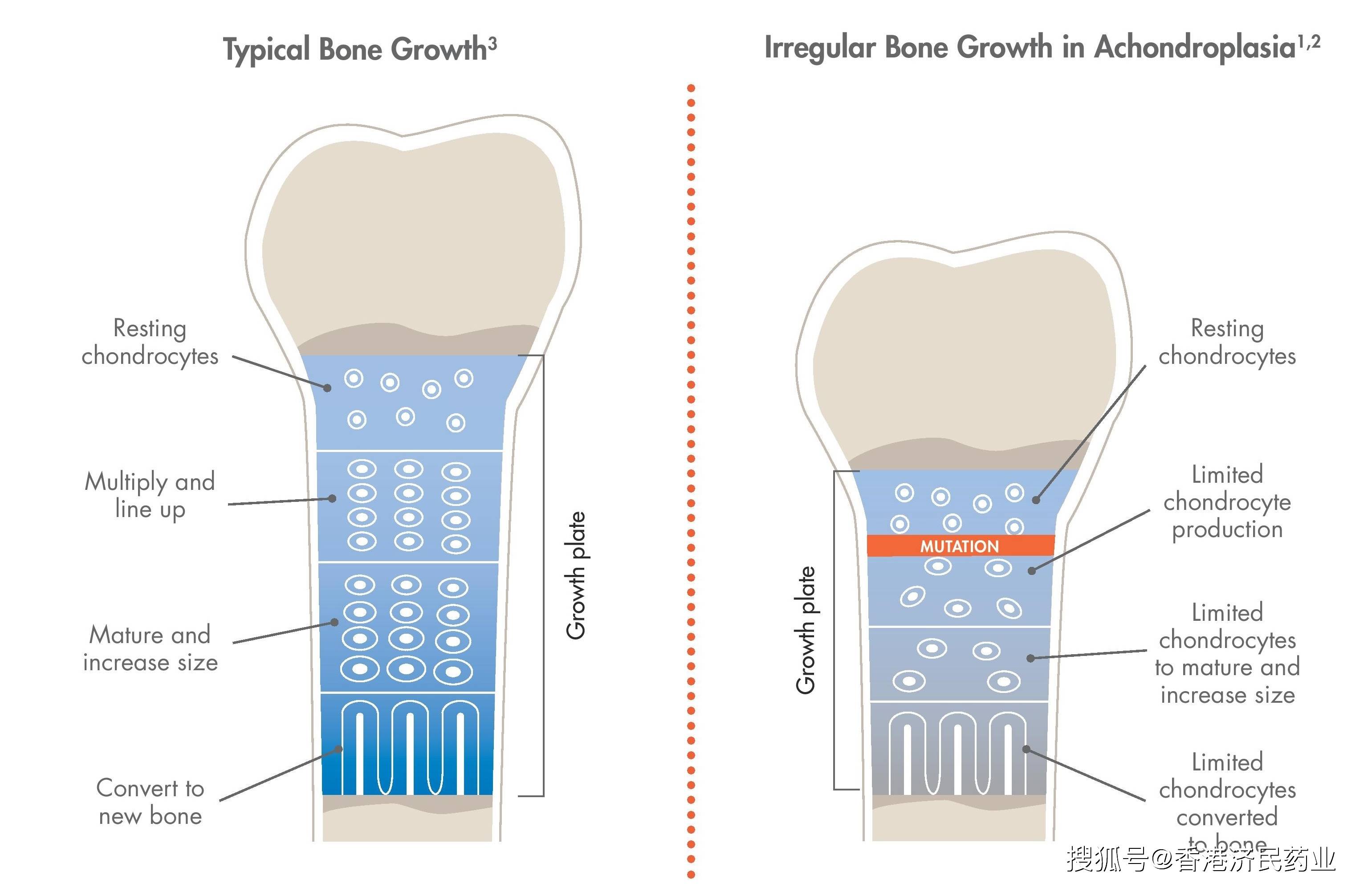 治疗软骨发育不全！靶向药VOXZOGO(vosoritide)获EC批准_Voxzogo