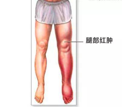 下肢静脉血栓的症状及预防图片 4003