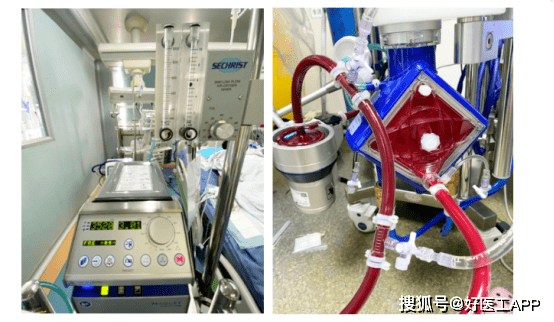 打破垄断，国产ECMO首次临床应用_血液_患者_氧合器