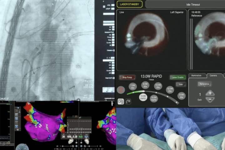 瑞金医院海南医院成功应用HeartLight X3球囊型激光消融技术治疗阵发性房颤_患者_手术_肺静脉