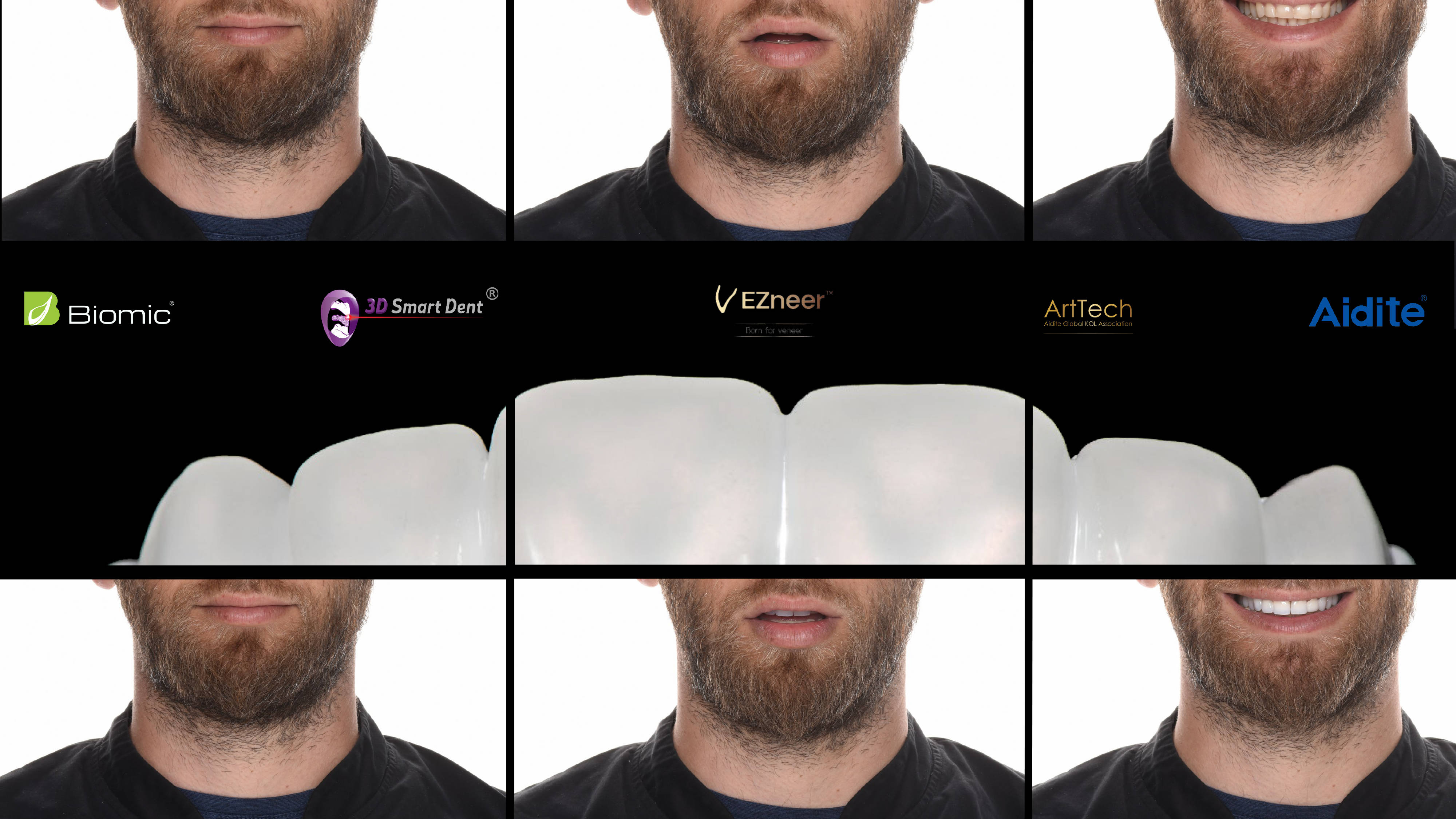 爱迪特 #EZneer病例赏析# Born for veneer!-搜狐大视野-搜狐新闻