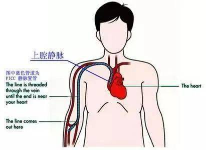 测量CVP，只可以使用CVC吗？_临床