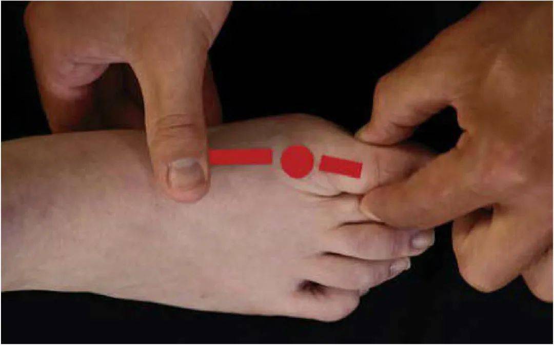 ROM｜第一跖趾（MTP）关节内收_活动