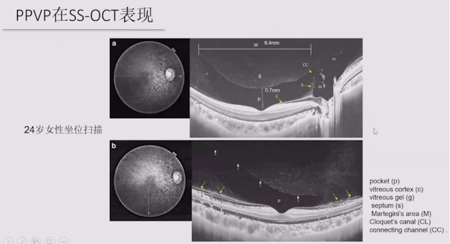 玻切新势力｜ 张喜梅：认识PPVP，助力人工PVD_玻璃体