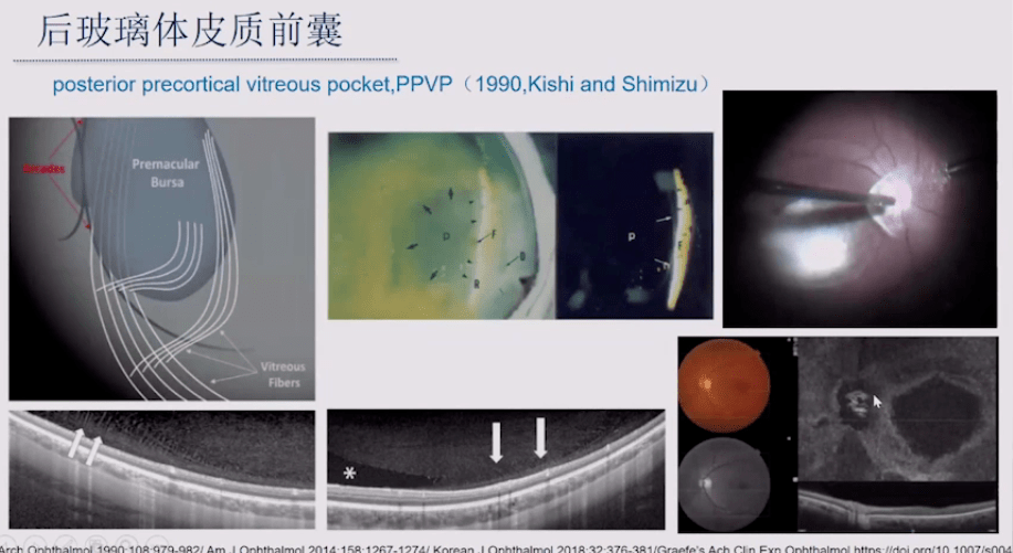 玻切新势力｜ 张喜梅：认识PPVP，助力人工PVD_玻璃体