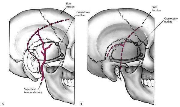 Thieme｜颞下入路图解_the_artery_and