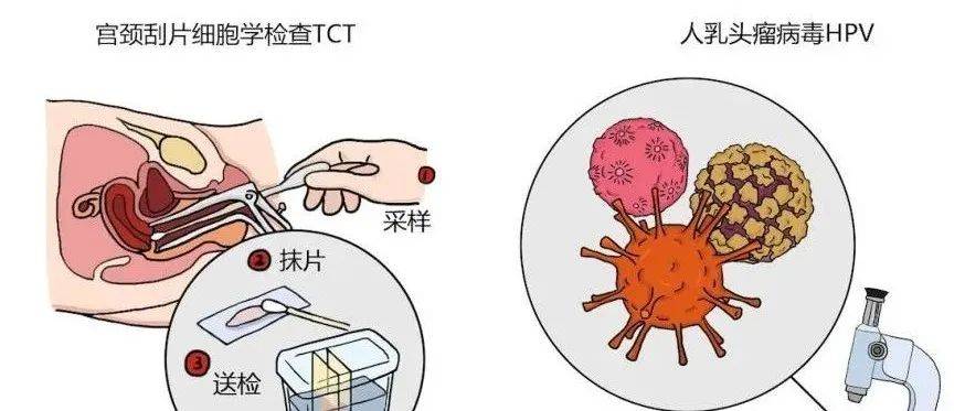【高阳妇幼•坚持人民至上】预防宫颈癌，到底是查hpv还是tct靠谱？检查筛查细胞学