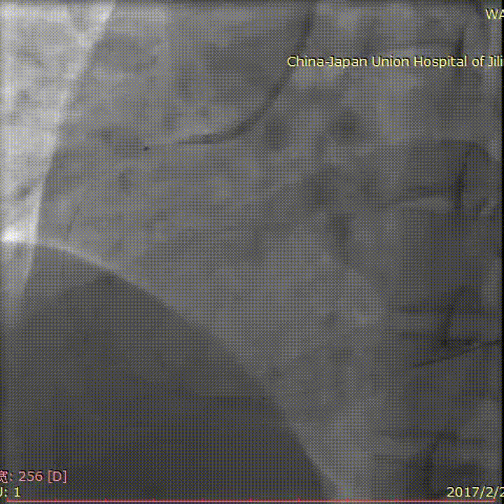 STEMI溶栓•经典病例｜急性心梗冠脉高血栓负荷处理一例_支架_松原_患者