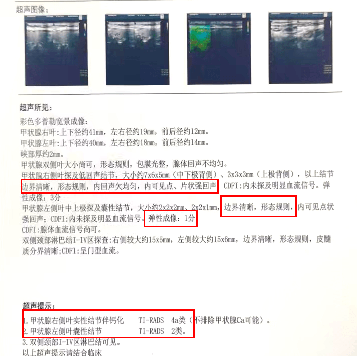 甲状腺结节4a类伴钙化严重吗?是否应该立即做手术？_治疗_患者_董方武