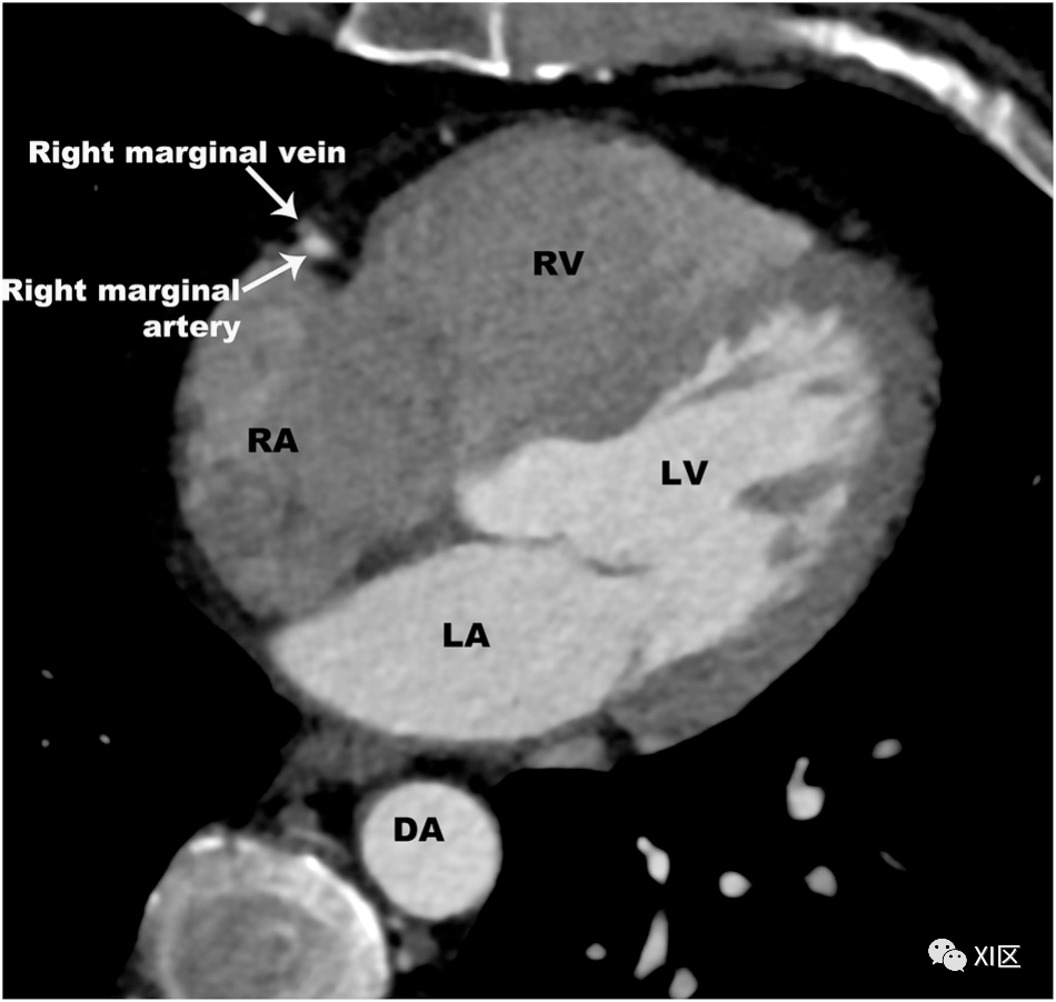 超清图！收藏！冠状静脉解剖与异常_veins_心脏_系统