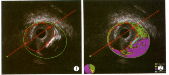 科普｜心内科医生的“火眼金睛”-冠脉内超声（IVUS）_胡大叔_血管_检查