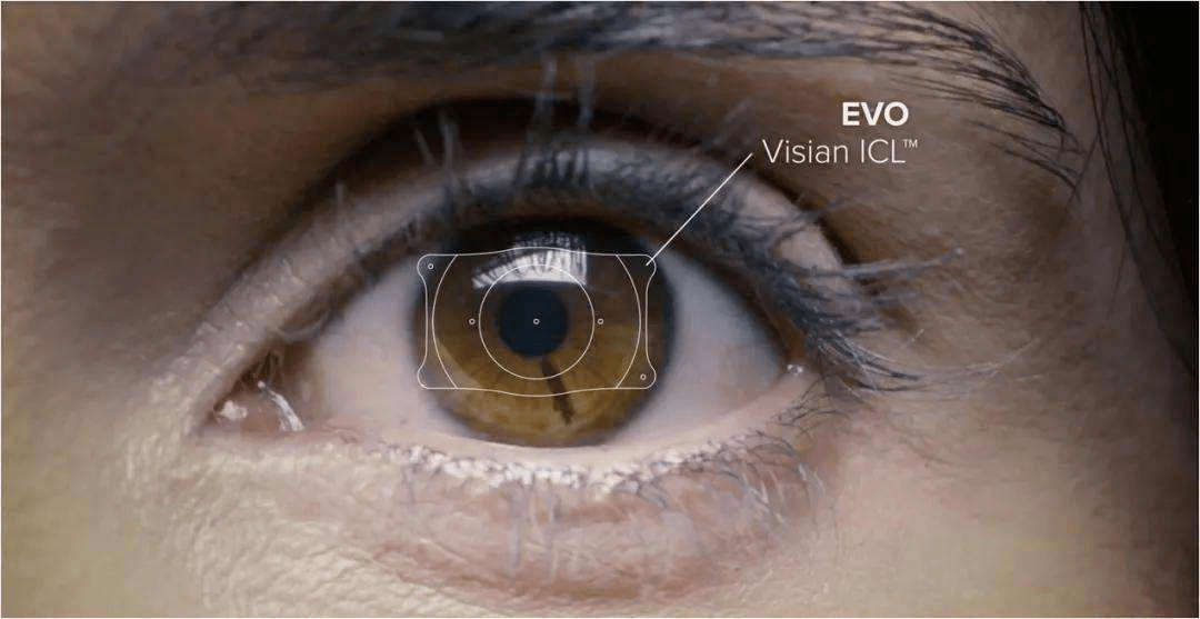 南阳南石眼科 | ICL检查手术全流程攻略，看这一篇就够了！_晶体_医生_患者