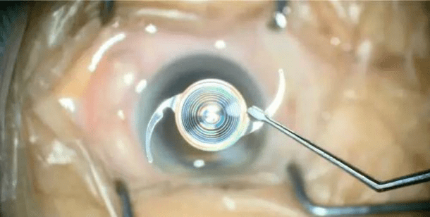 【ACD详细解析】一文读懂：前房深度_晶状体_屈光_mm