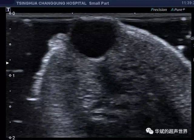 典型病例•中缝囊肿（ Median Raphe Cysts）_阴茎_尿道_中线