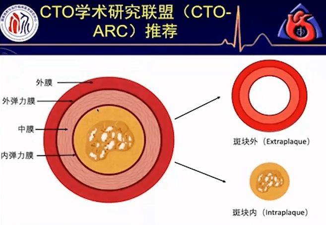 心讲座 | 葛雷：冠脉CTO手术策略与进展——CTOCC CTO PCI流程图更新版解读_钢丝_技术_血管