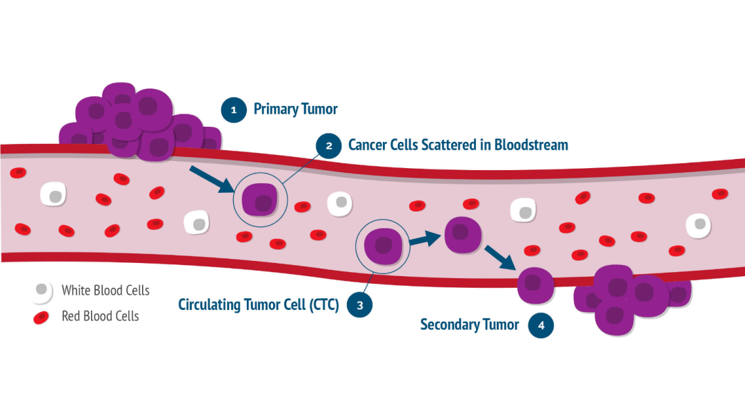 前沿 | CTC建功？结肠癌血液筛查现出曙光，CellMax Life的前瞻性筛查数据出色，FDA申报进程稳步推进中_研究_检测_灵敏度
