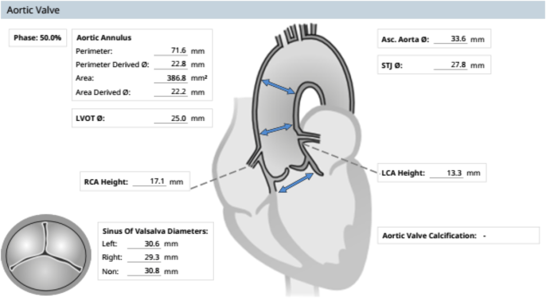 成都市第五人民医院心血管内科郎明健团队成功完成高龄极重度钙化合并慢阻肺TAVR一例_患者_瓣膜_主动脉