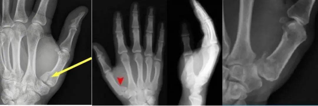 你都懂了吗？第一掌骨基底部骨折中的Bennett、Rolando、Winterstein骨折！_关节_拇指_检查