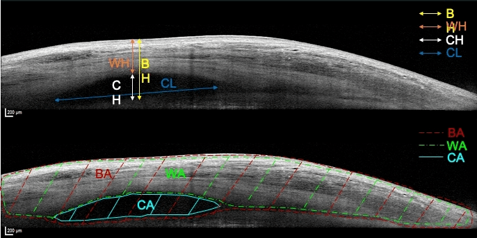 ARVO最“HOT”之青光眼诊疗领域的新发现_风险_研究_进行了