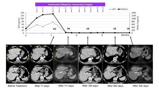 肝癌免疫治疗后进展，结局竟然完全缓解？_患者_利珠_肿瘤