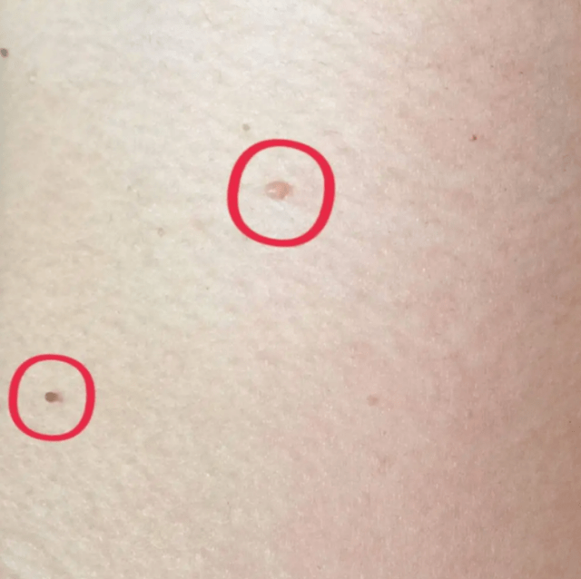 脖子和腋下的 小肉粒”是什么？能直接用手揪掉吗？看完要记牢方法颈部情况