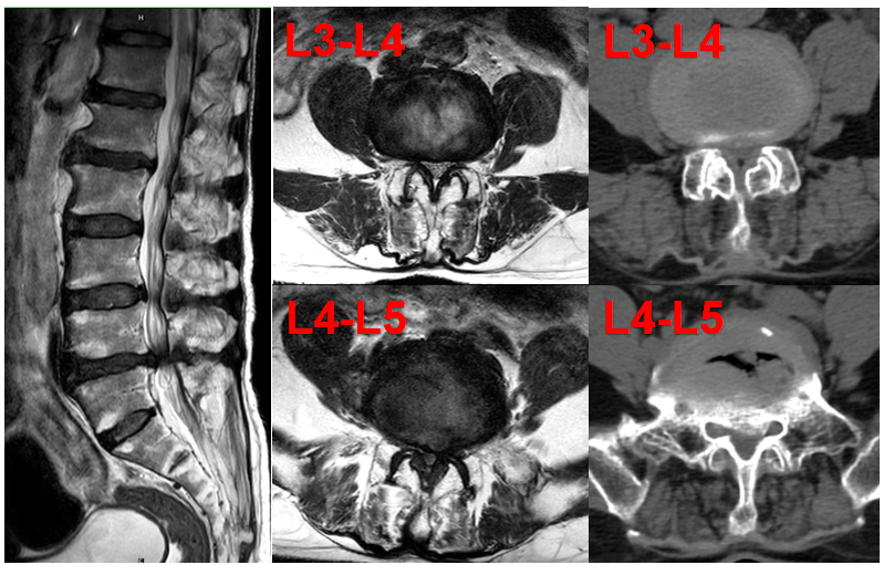 首创！北京友谊医院成功开展双术者同台UBE-ULBD微创手术，治疗双节段腰椎管狭窄症患者_临床_脊柱_症状