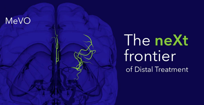 MeVO：The Next Frontier VI——哪些MeVO患者更倾向于EVT治疗？_诊断_支架_血管